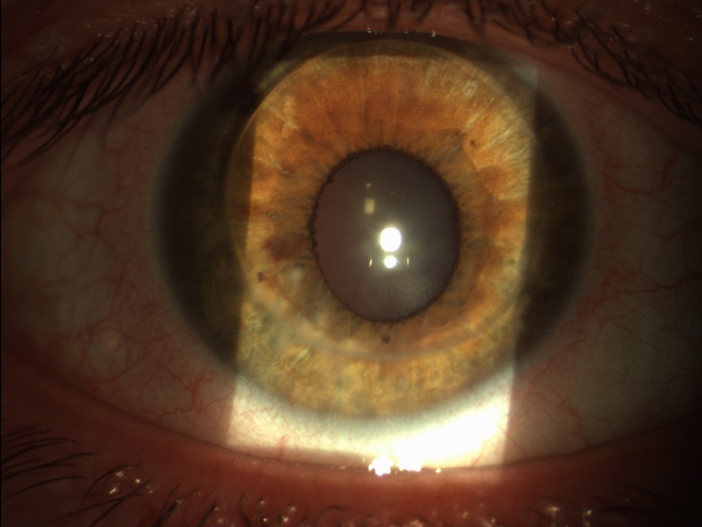 Proper management of the post-operative step - Oculista Italiano