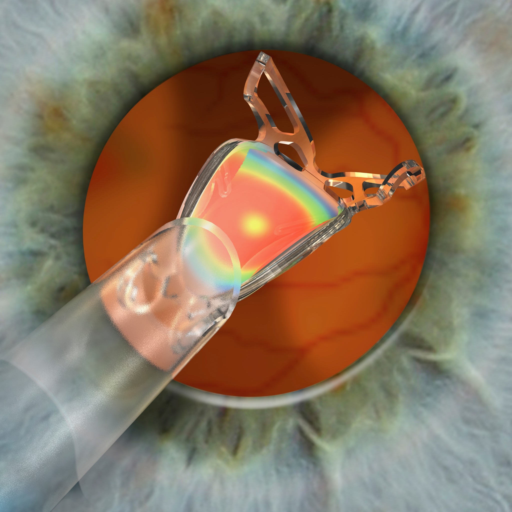 MINI WELL Ready IOL, A premium solution for Extended Range of Vision ...