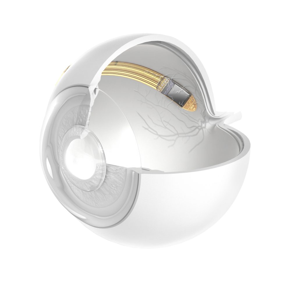 Artificial retina: a microchip can restore sight - Oculista Italiano