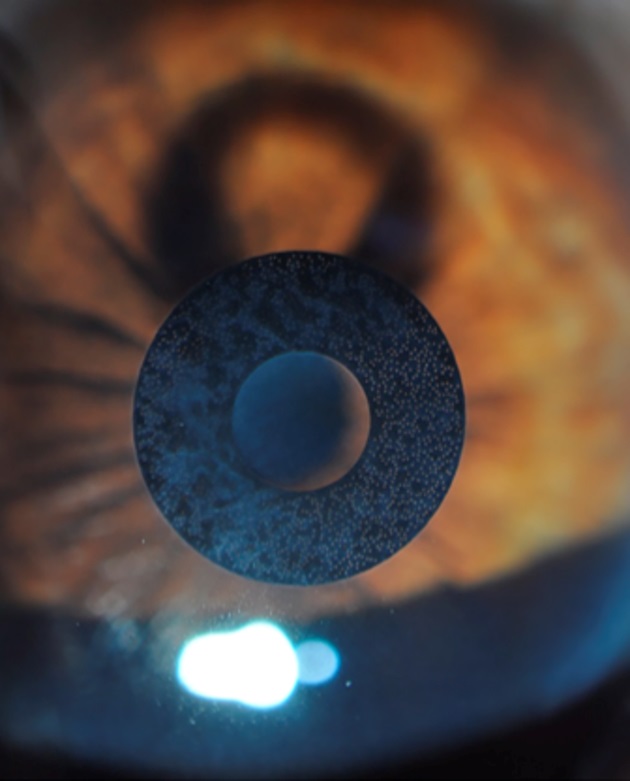 Surgical Options for Multifocality - Oculista Italiano