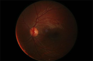 Neuropatía óptica de Leber - Oculist Italiano