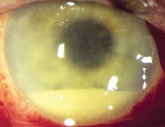 Endoftalmite: tassi in decrescita - Oculista Italiano