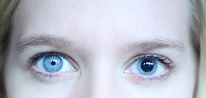 Anisocoria: What is it and why does it occur? - Italian Ophthalmologist