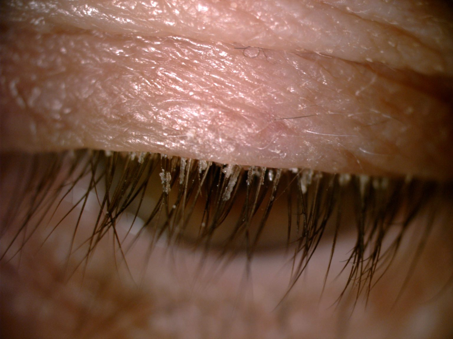 Blefarite: una patologia complessa - Oculista Italiano