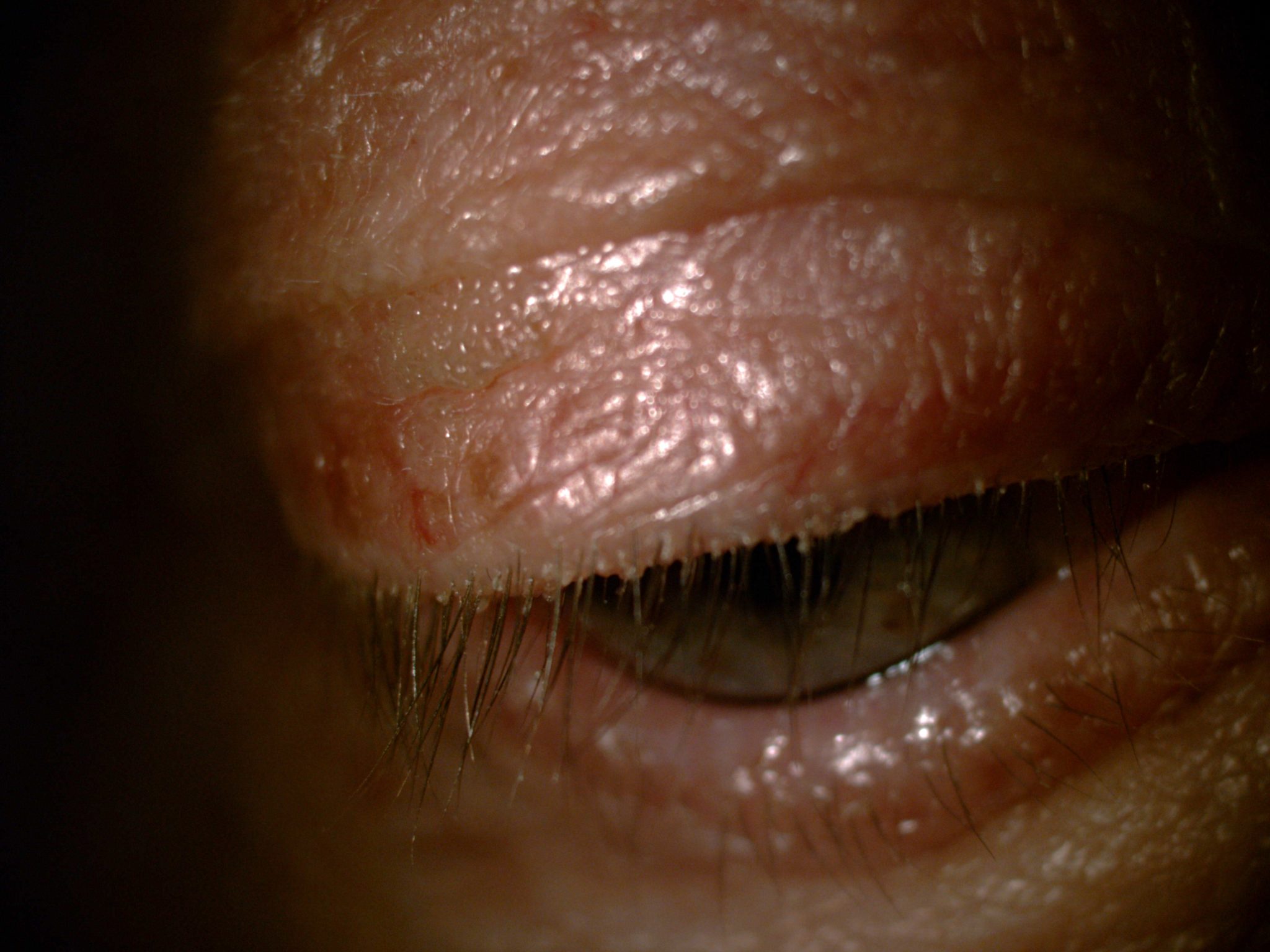 Blefarite: una patologia complessa - Oculista Italiano