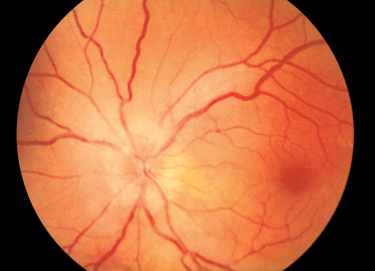Neuropatia ottica ischemica anteriore - Oculista Italiano